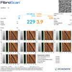 Your Fibroscan results explained - The Liver Clinic